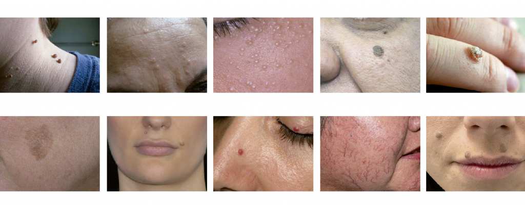 Láser azul Blauman - BCN Estética Avanzada